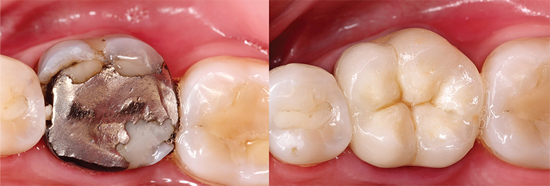 Dental Press – Endocrown passo a passo: do laboratório à clínica