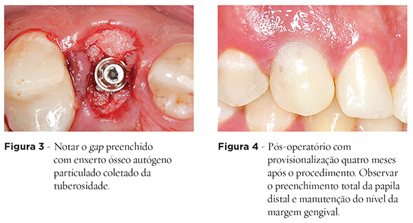 Dental Press – Comportamento dos tecidos peri-implantares no implante ...