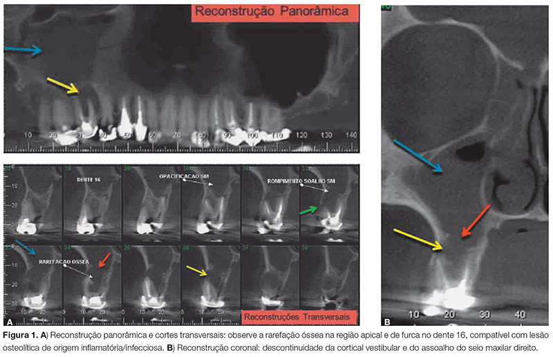 Dental Press | Sinusite do seio maxilar de origem odontogênica