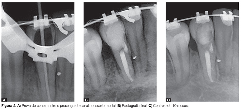 Dental Press | Emprego do MTA no tratamento de perfuração radicular ...