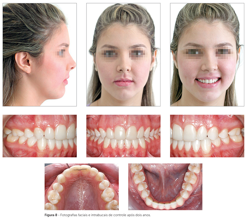 Dental Press | Má oclusão Classe II de Angle, tratada com extrações de ...
