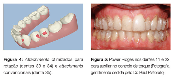 Dental Press – Afinal, o que podemos esperar do sistema Invisalign?