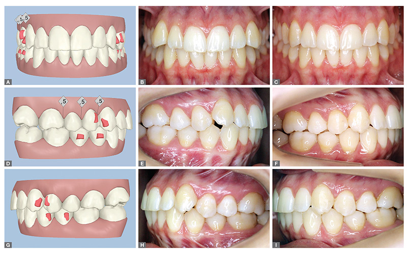Afinal, o que podemos esperar do sistema Invisalign? – Dental Press
