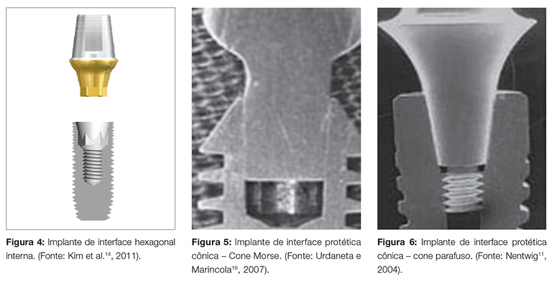 Dental Press | Estudo biomecânico das interfaces protéticas
