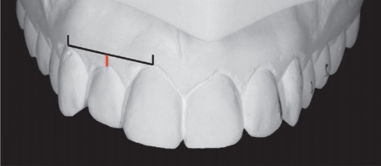 Dental Press – Análise da proporção largura/altura e zênite gengival em ...