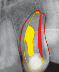 Dental Press |Tratamento endodôntico de dens invaginatus: casos clínicos