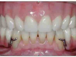 Dental Press – Tratamento para estomatite protética é tema de pesquisa ...