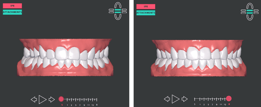Dental Press – Alinhadores Clearcorrect: Da submissão simples ao Set Up Personalizado