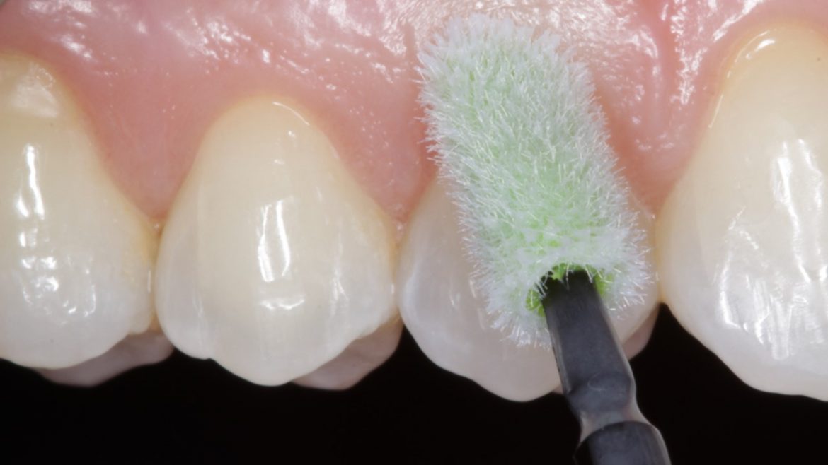 Dental Press – Caso clínico - Hipersensibilidade dentinária e prevenção ...