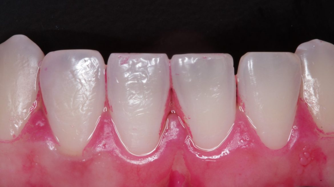 Dental Press – Caso clínico - Hipersensibilidade dentinária e prevenção ...