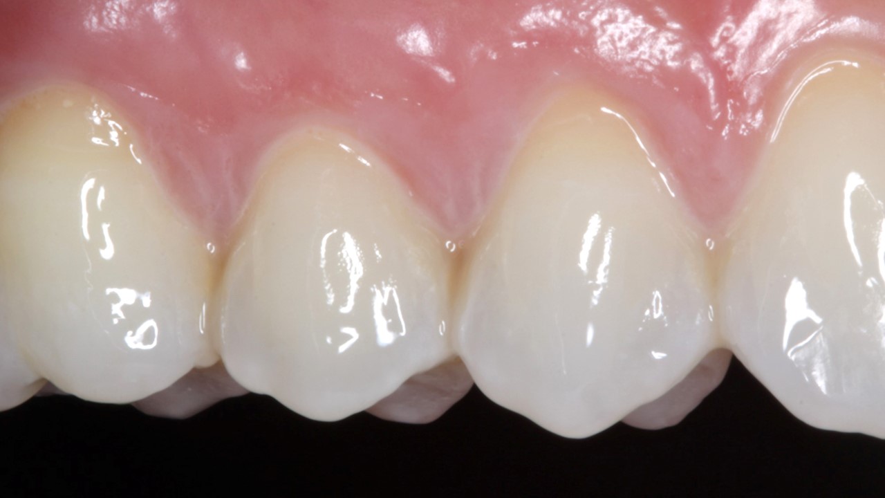 Dental Press – Caso clínico - Hipersensibilidade dentinária e prevenção ...